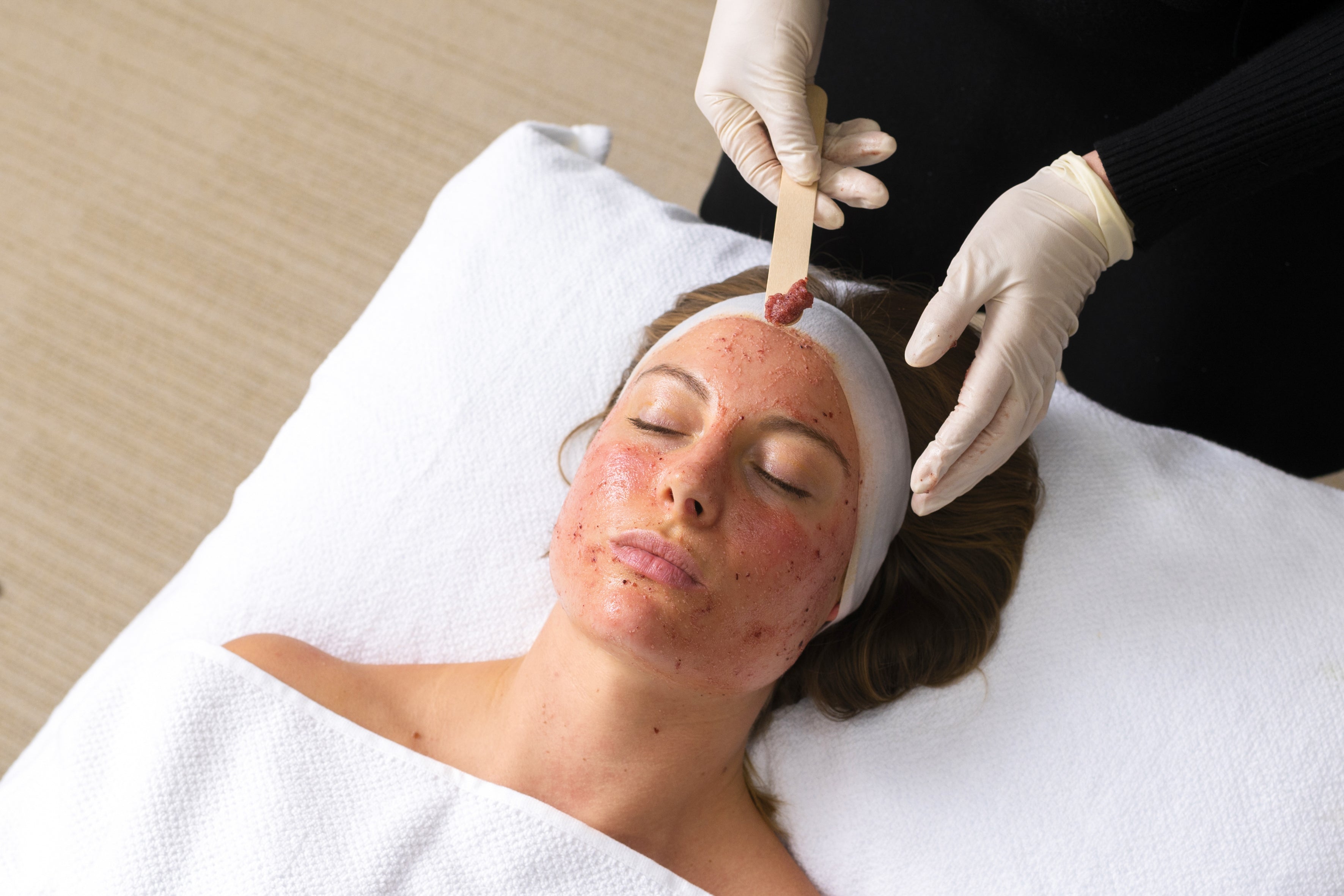 Chemical Face Peel: Just What You Need For Better Skin