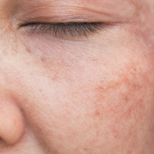 What Is Melasma and How To Treat It? - The Clinic Bondi