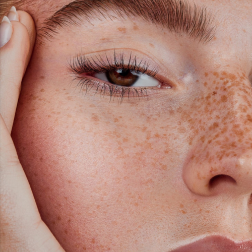 Understanding Pigmentation: The Types and Causes - The Clinic Bondi